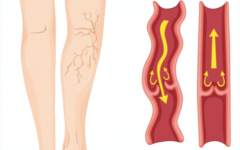 Blog - Médicos Angiologistas em Goiânia – As melhores técnicas de ...